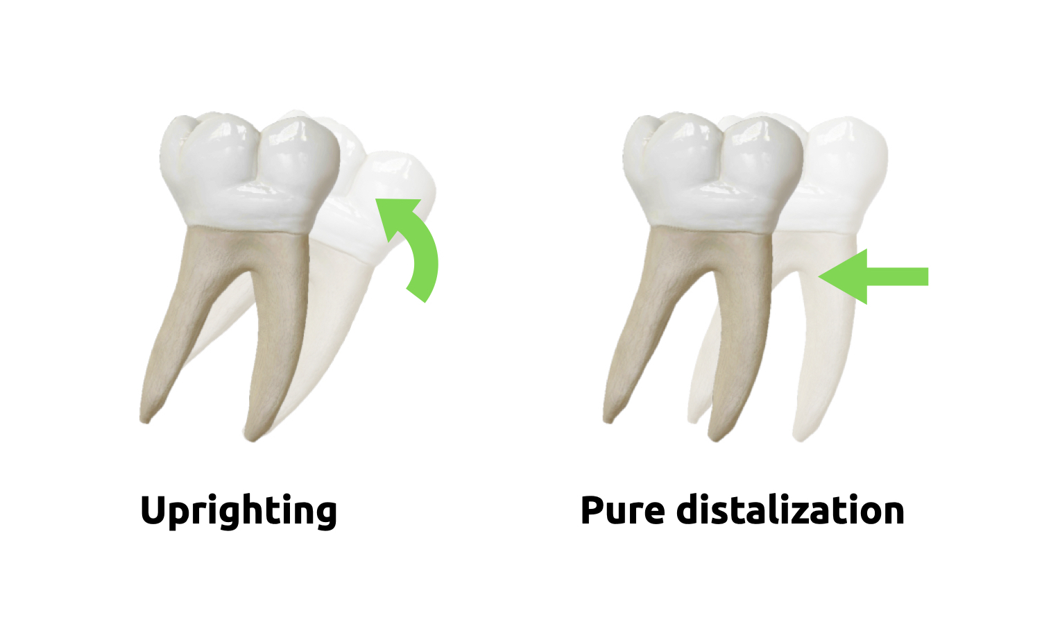 Can we distalize on the mandible? – Orthodontic Grammar