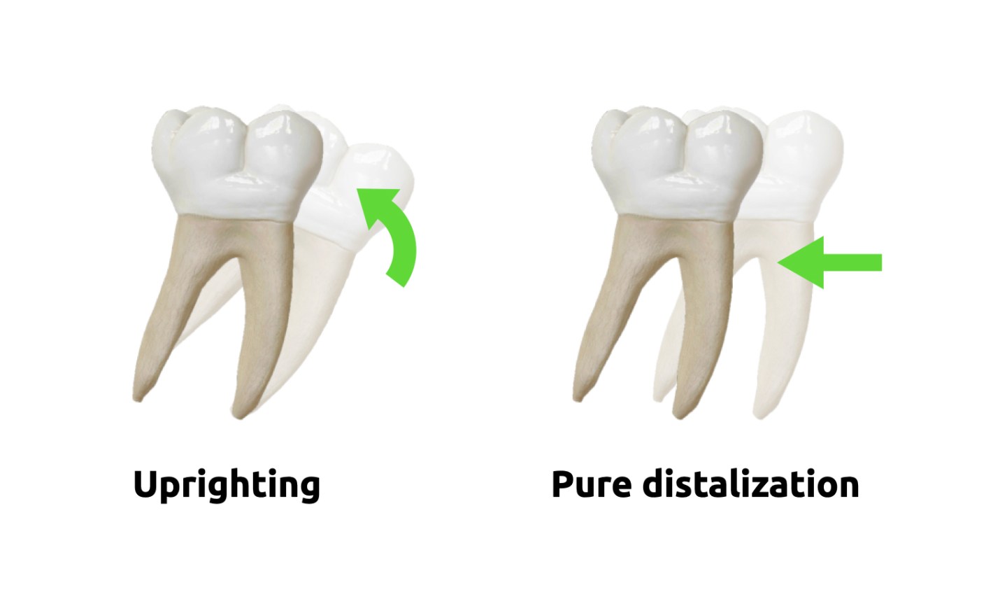 Can we distalize on the mandible? – Orthodontic Grammar